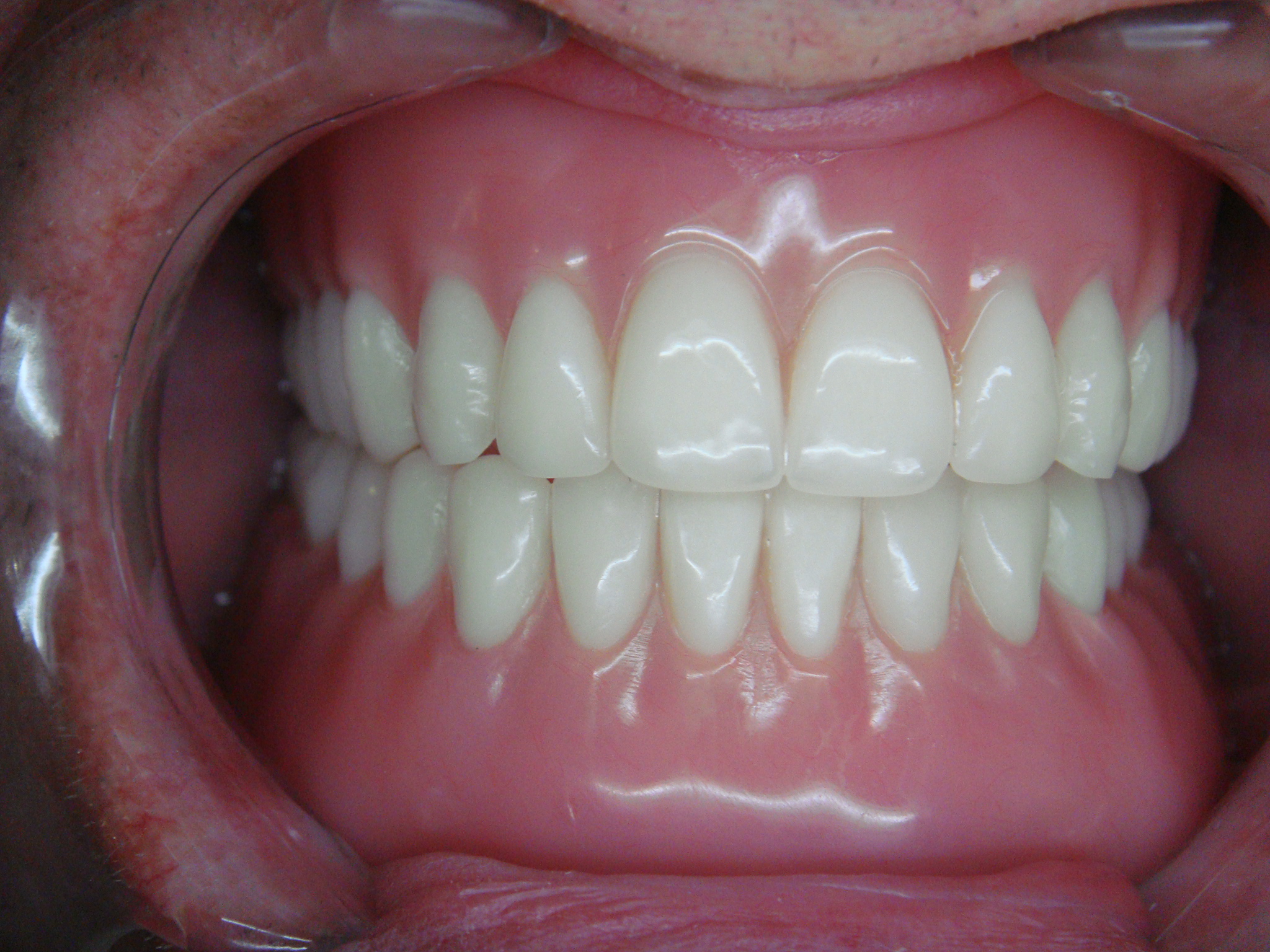 Before After - Aesthetic Dentures in Bangkok, Thailand at Dr. Sunil ...