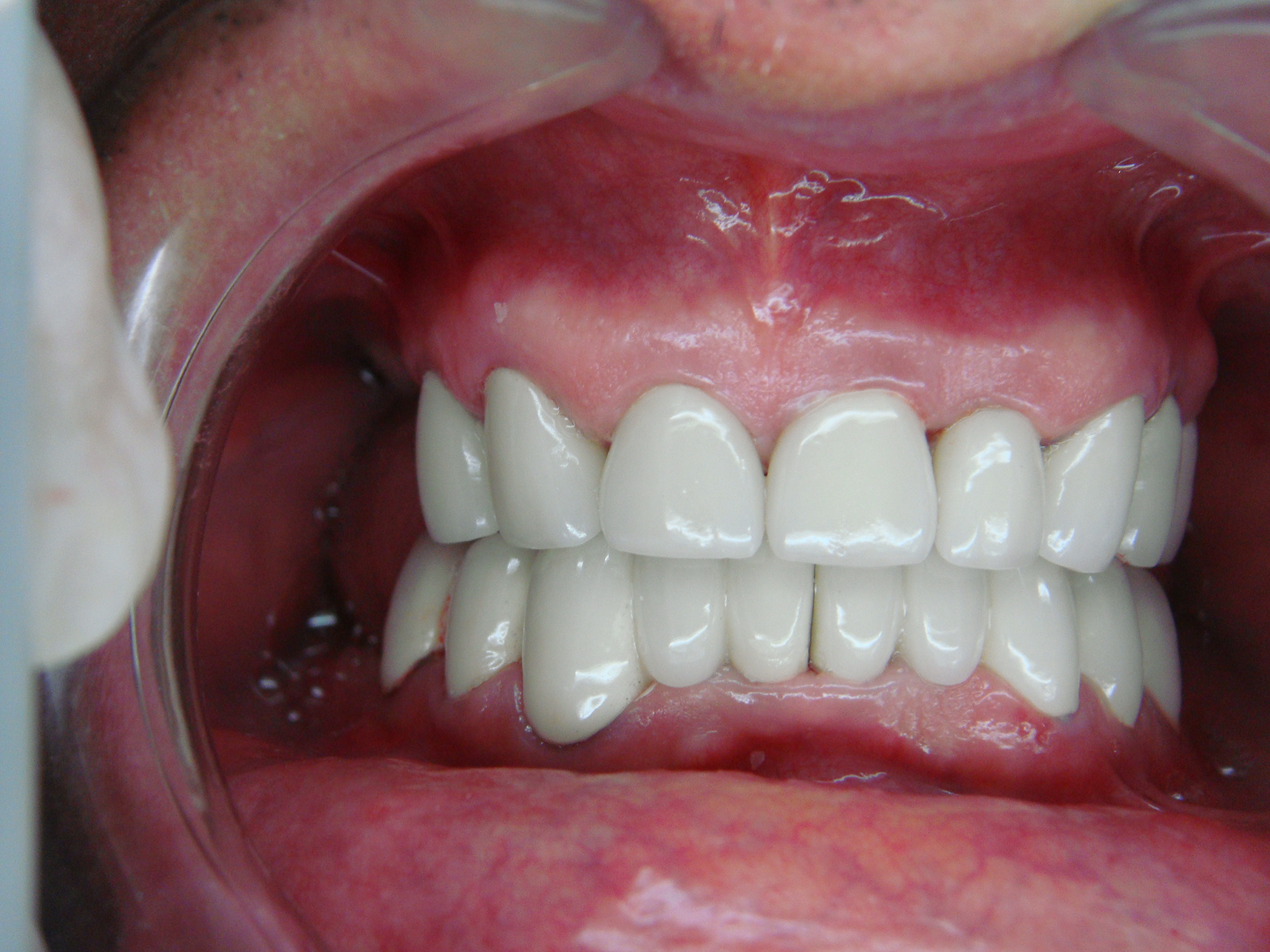 Before After - Full Mouth Reconstruction in Bangkok, Thailand at Dr ...