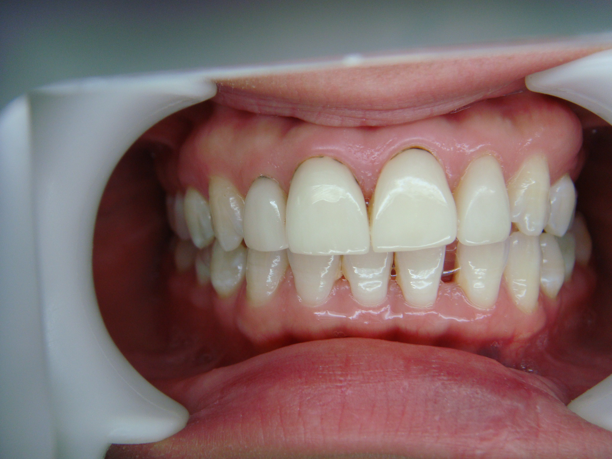 Before After - Porcelain Veneer in Bangkok, Thailand at Dr. Sunil ...