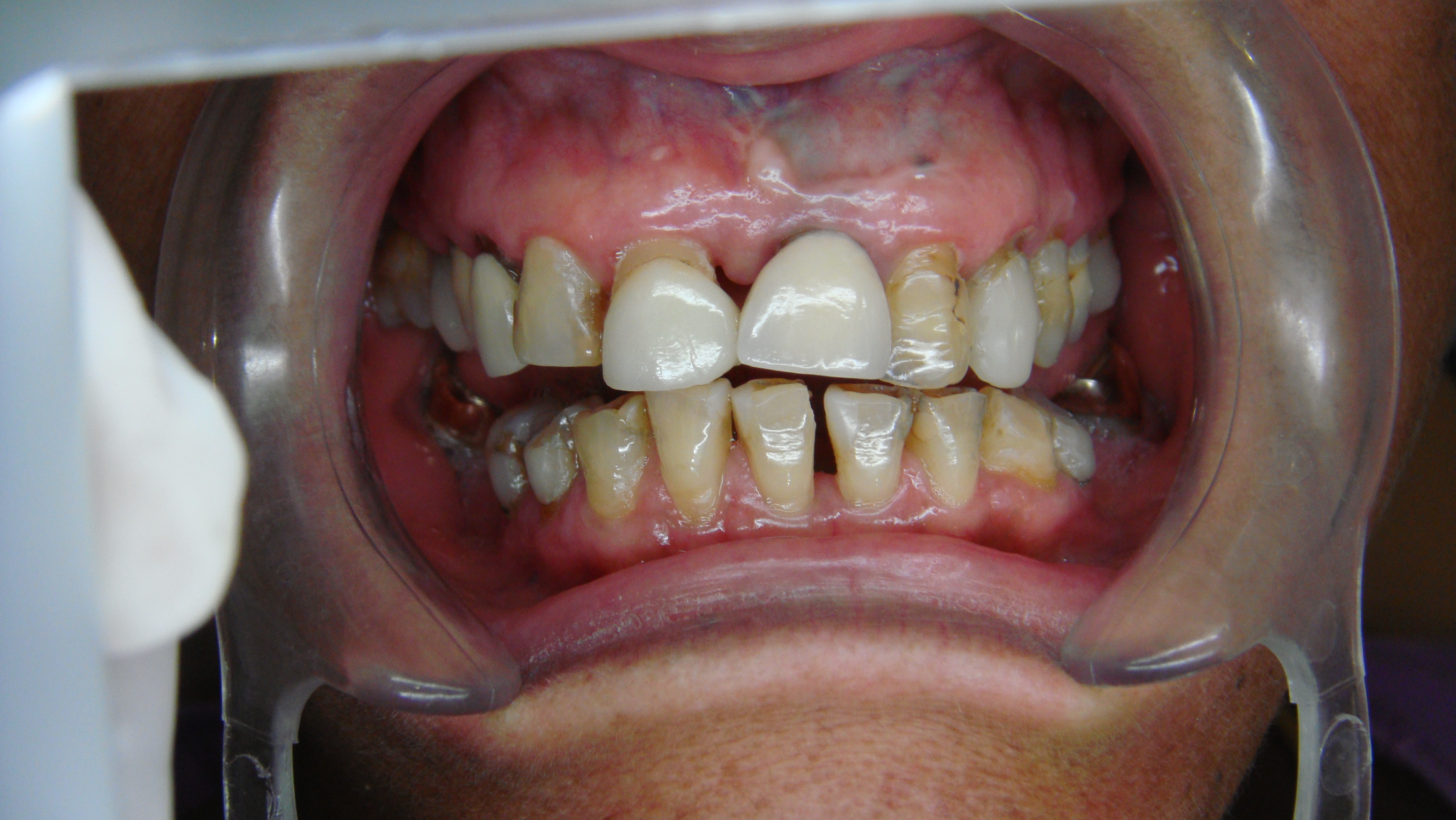 Before After - Full Mouth Reconstruction in Bangkok, Thailand at Dr ...