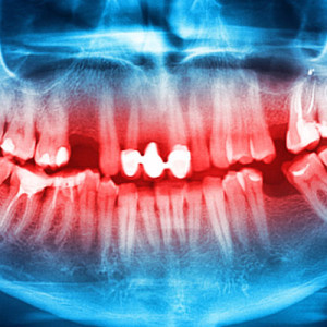 Tooth Pathology - Dr Sunil Dental Blog